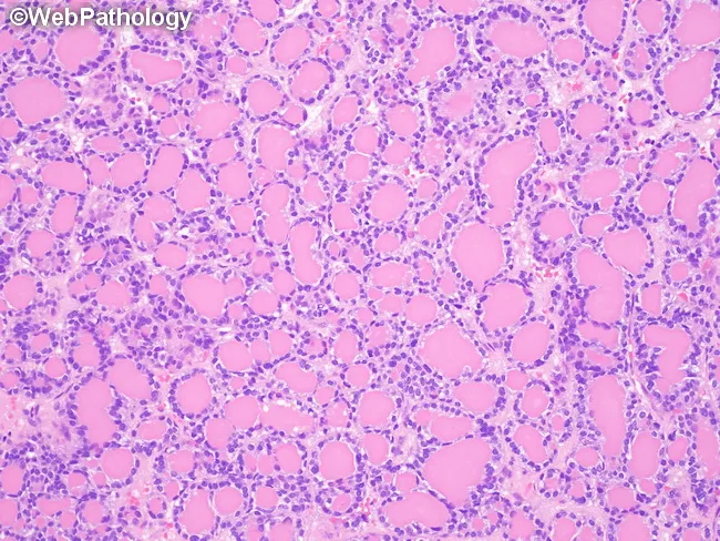 Metastatic Papillary Thyroid Carcinoma, Follicular Variant