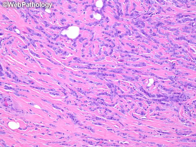 Infiltrating Lobular Carcinoma