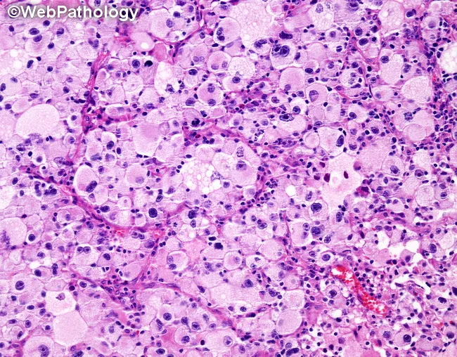 Metastatic Balloon Cell Melanoma