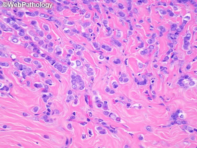 Infiltrating Lobular Carcinoma