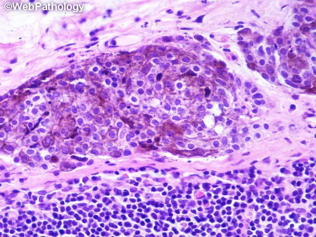 Nevus Cell Inclusions