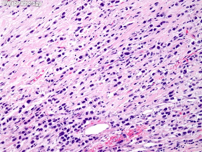 Pleomorphic Lobular Carcinoma