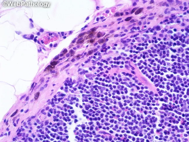 Nevus Cell Inclusions