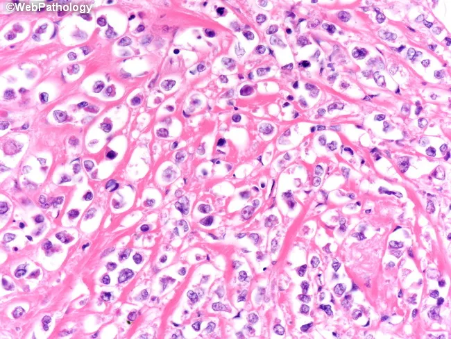 Pleomorphic Lobular Carcinoma