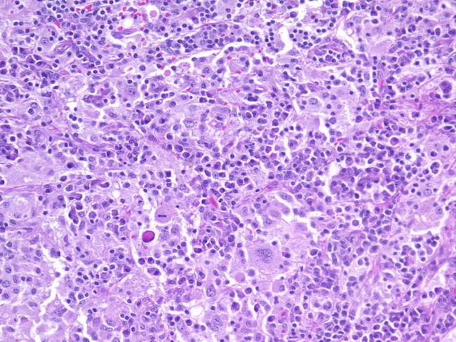 Extranodal Rosai-Dorfman Disease : Orbit