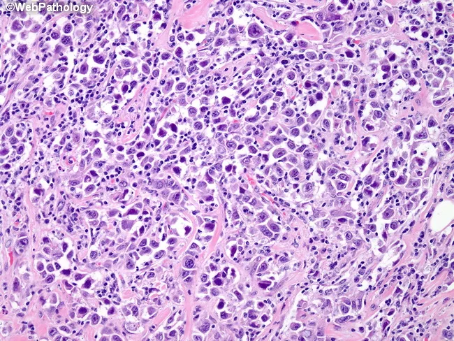 Pleomorphic Lobular Carcinoma