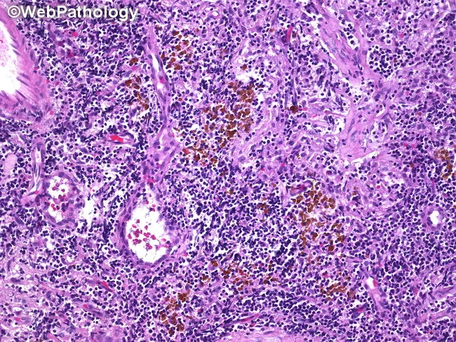 Intranodal Palisaded Myofibroblastoma