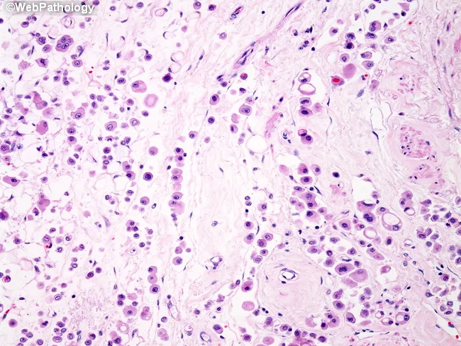 Histiocytoid Carcinoma
