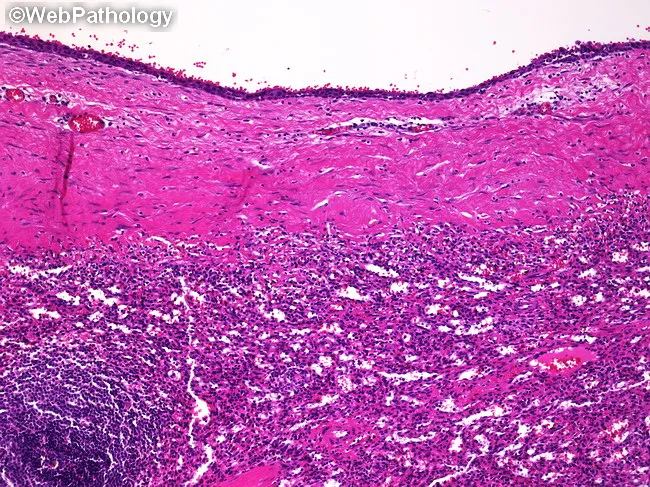 Epithelial Cyst of Spleen