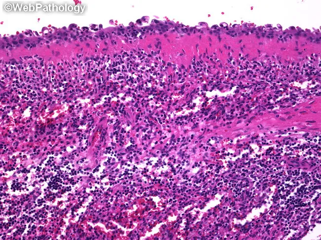 Epithelial Cyst of Spleen