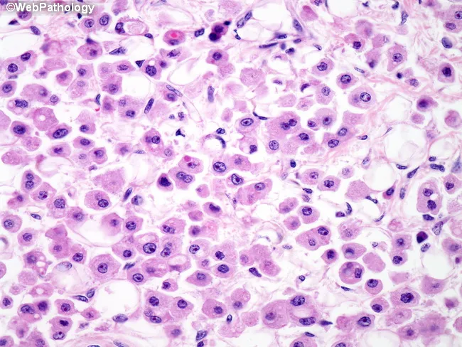 Histiocytoid Carcinoma
