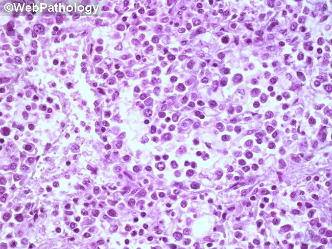 CML in Blast Transformation