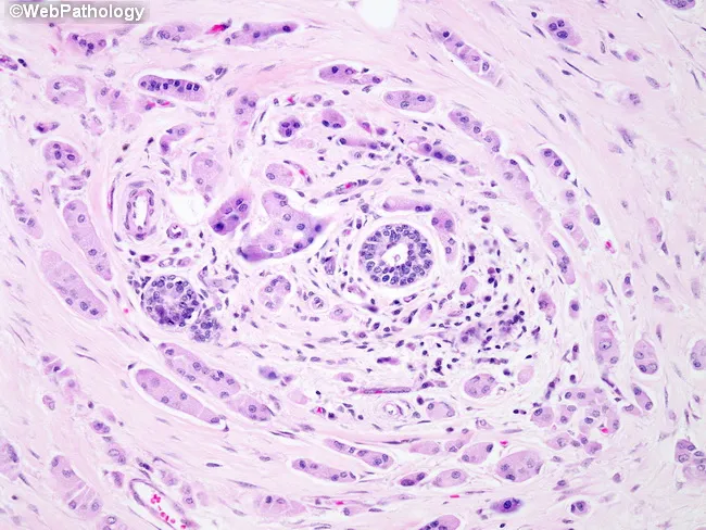 Histiocytoid Carcinoma