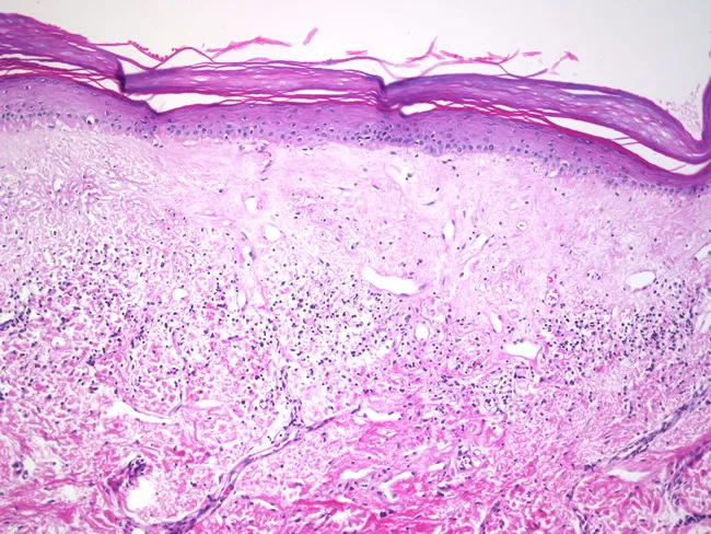 Lichen Sclerosus Histology Frühtherapie Rettet Sexualleben