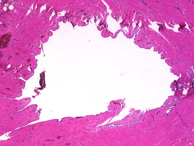 Gartner Duct Cyst Pictures Of S