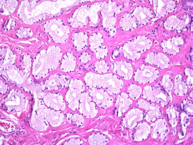 Hyperplasia of Bartholin Glands