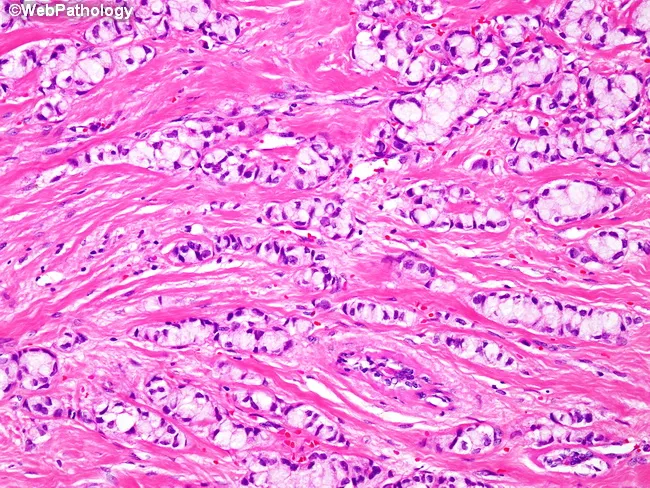 Signet Ring Cell CA : Breast