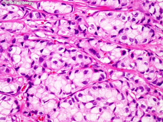 Signet Ring Cell CA : Breast