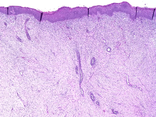 Aggressive Angiomyxoma : Microscopic