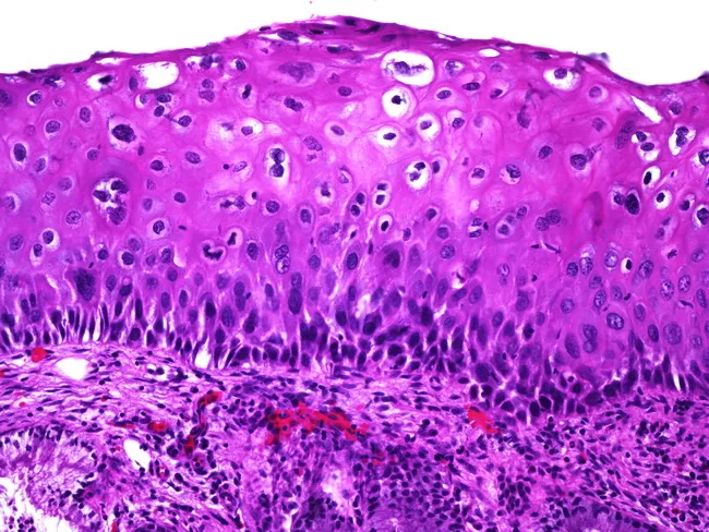 Flat Condyloma