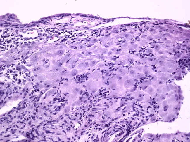 Decidual Reaction in Cervix