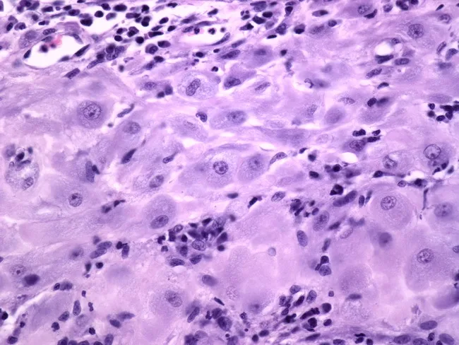 Decidual Reaction in Cervix