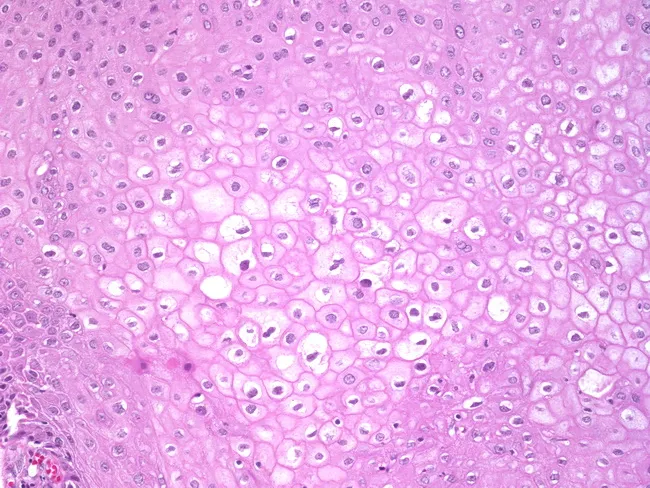 koilocytes cervix