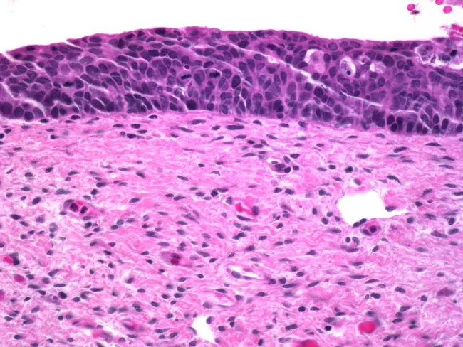 High-grade Squamous Intraepithelial Lesion (CIN III, Carcinoma-in-situ)