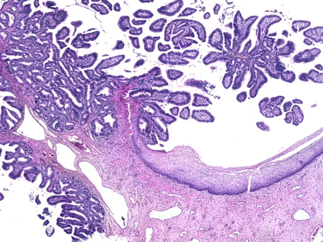 Villoglandular Adenocarcinoma of Cervix