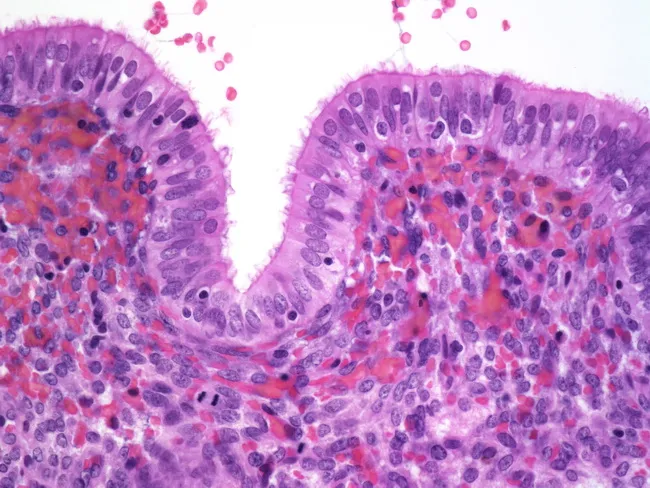 Ciliated Cell (Tubal) Metaplasia