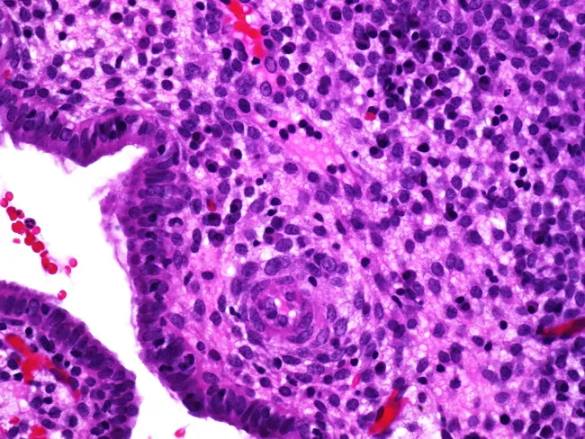 Chronic Endometritis