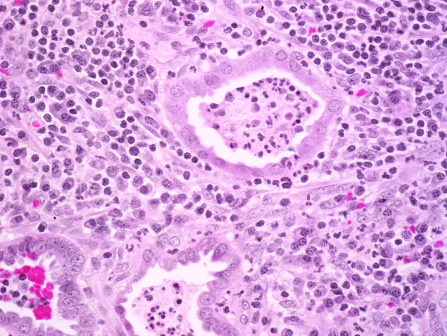 Chronic Endometritis