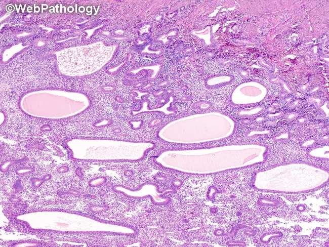 normoblastic hyperplasia