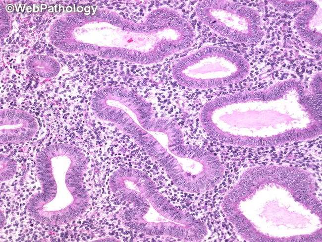 normoblastic hyperplasia