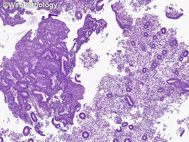 Atypical Endometrial Hyperplasia : Morphology