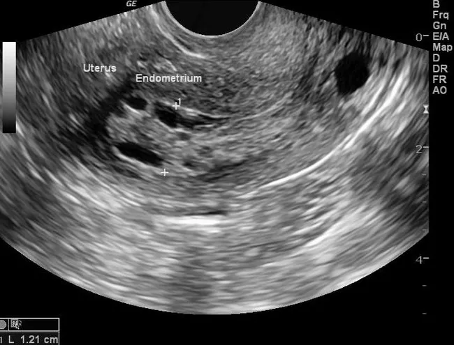 uterine lining thickness postmenopausal