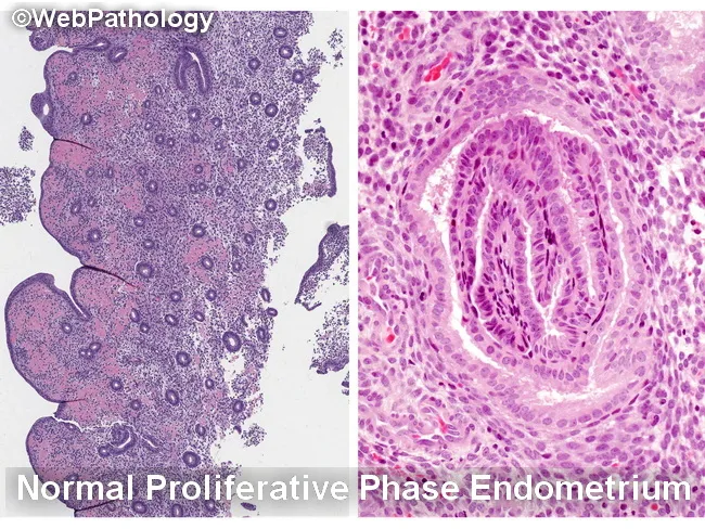 Endometrial Hyperplasia : Differential Diagnosis