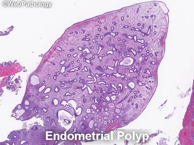 Endometrial Hyperplasia : Differential Diagnosis