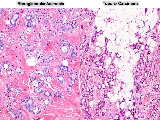 Tubular Carcinoma vs Microglandular Adenosis