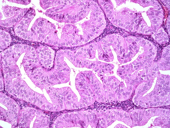 Endometrioid Adenocarcinoma, FIGO Grade 1