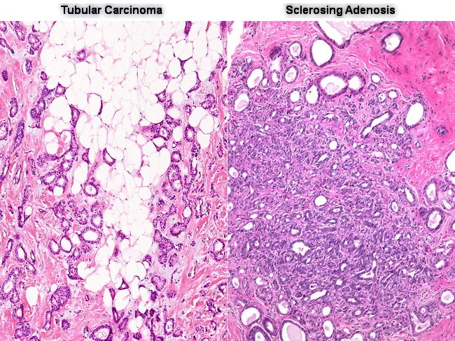 Tubular Carcinoma vs Sclerosing Adenosis