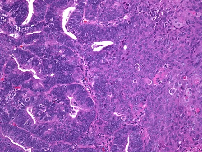 Endometrioid AdenoCA, Grade 1, with Squamous diff.