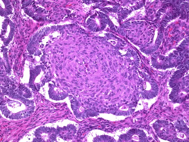 Endometrioid AdenoCA, FIGO Grade 1, with Squamous diff.
