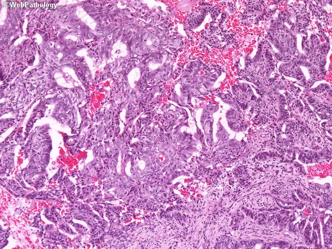 Endometrioid Adenocarcinoma, FIGO Grade 2