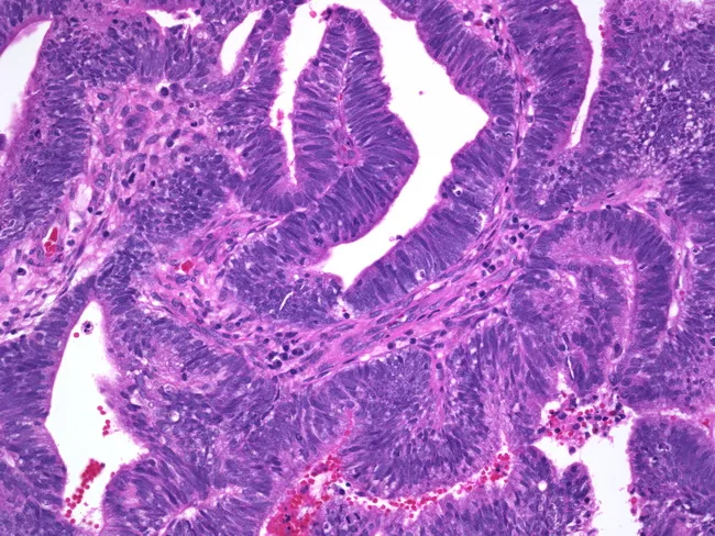 Endometrioid Carcinoma - Villoglandular type