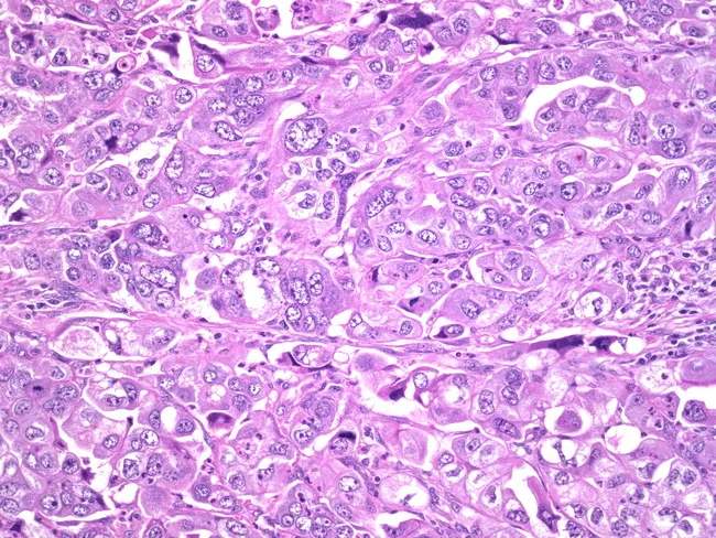 Clear Cell Carcinoma of Endometrium