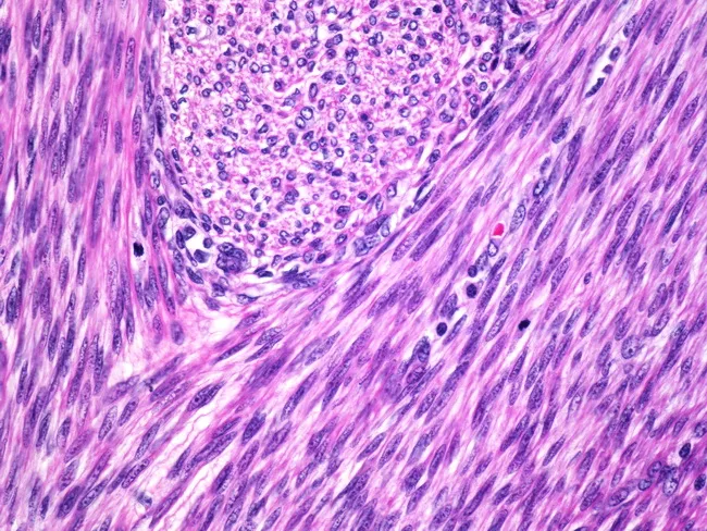 Mitotically Active Leiomyoma of Uterus