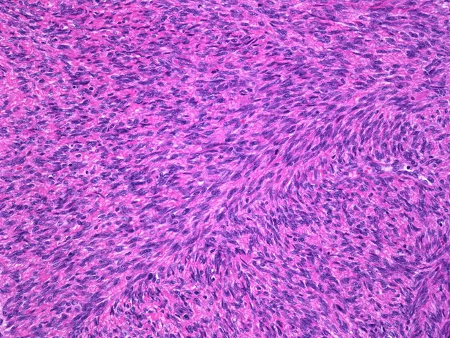 Cellular Leiomyoma of Uterus