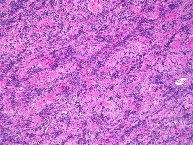 Leiomyoma of Uterus showing Nuclear Palisading