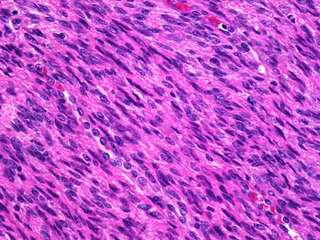 Cellular Leiomyoma of Uterus